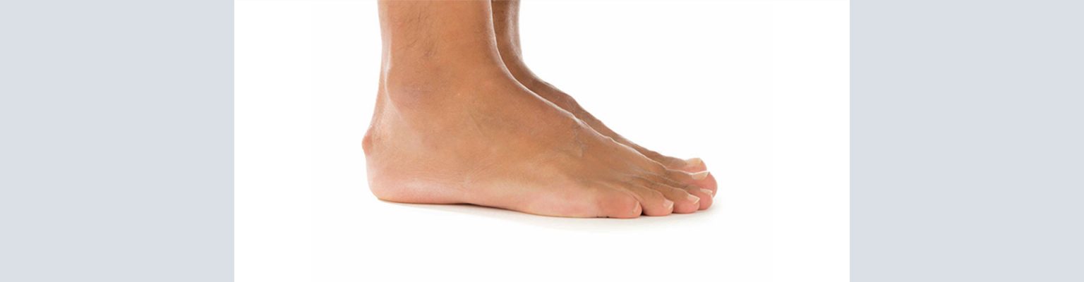 Παραμόρφωση Haglund | Αιτίες, Συμπτώματα, Θεραπεία